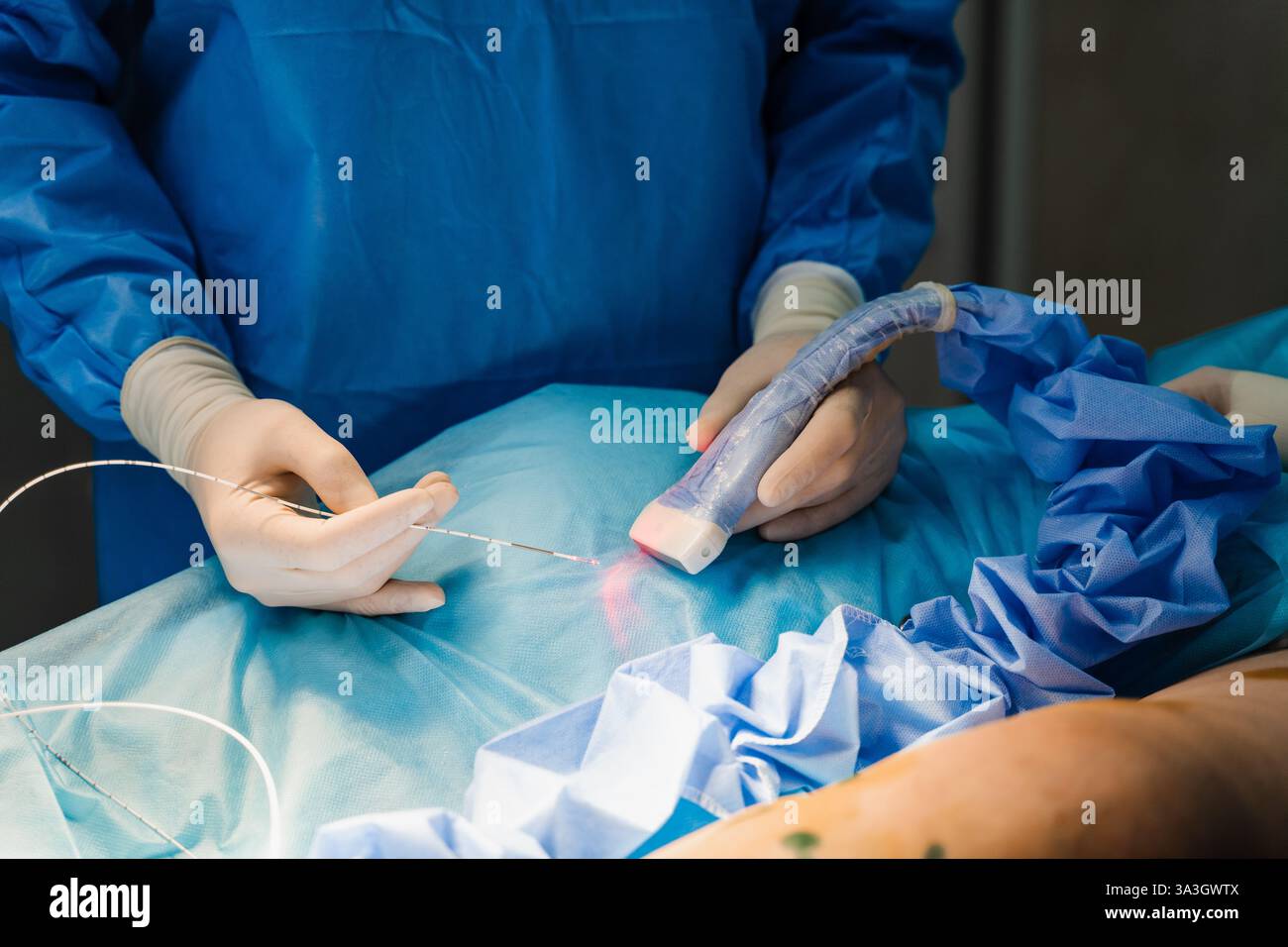 Endovenous laser coagulation for treatment varicose veins and ...