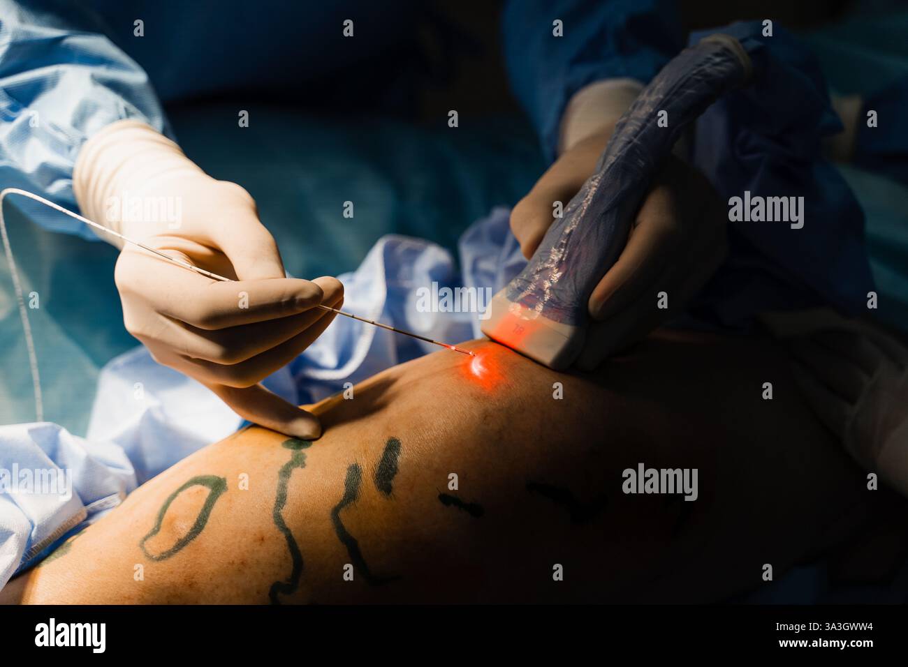 Endovenous laser coagulation for treatment varicose veins and ...