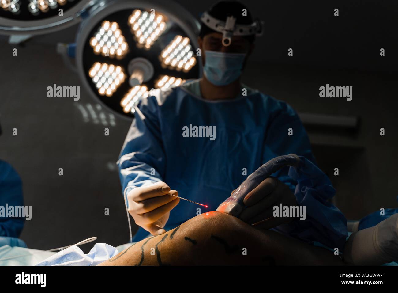 Endovenous laser coagulation for treatment varicose veins. Vascular ...