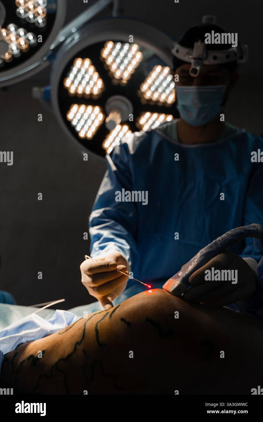 Endovenous laser coagulation for treatment varicose veins. Vascular ...