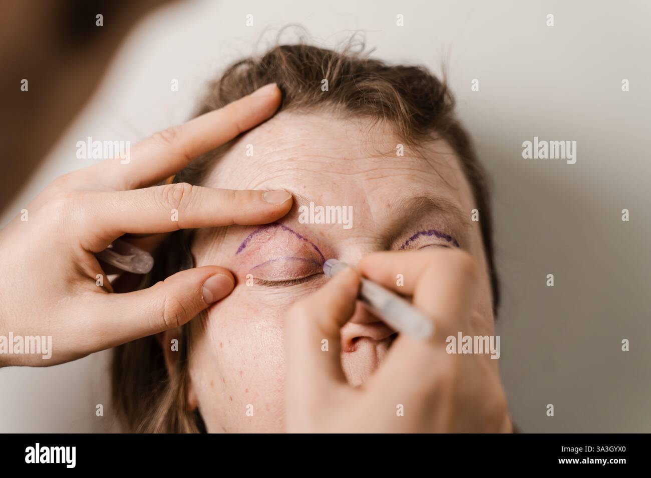 Blepharoplasty markup close-up on the face before the plastic surgery ...