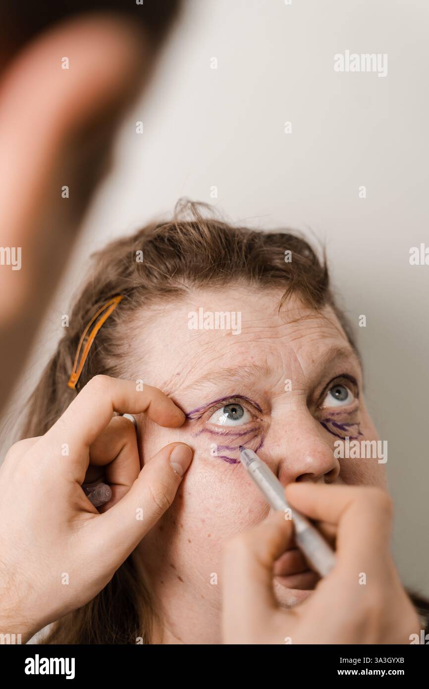 Blepharoplasty markup close-up on the face before the plastic surgery ...