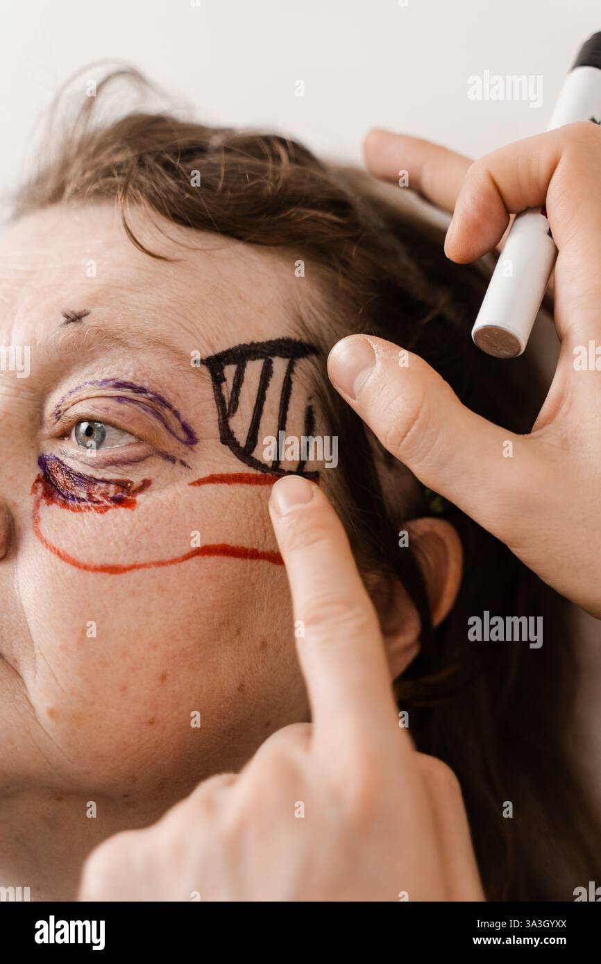 Browpexy markup close-up on the face for brow lift before the plastic ...