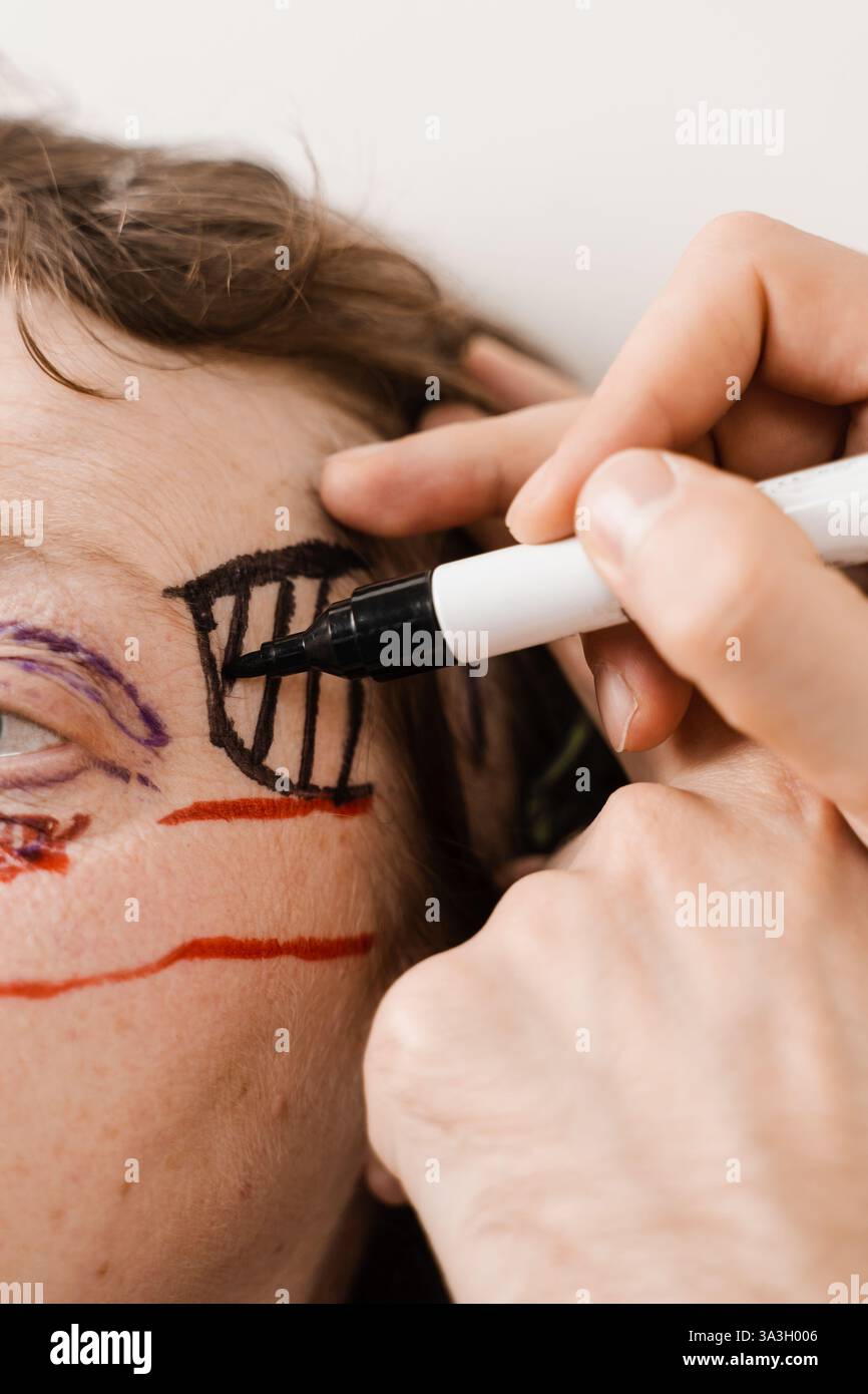 Brow lifting browpexy is a suture suspension of the brow to the ...