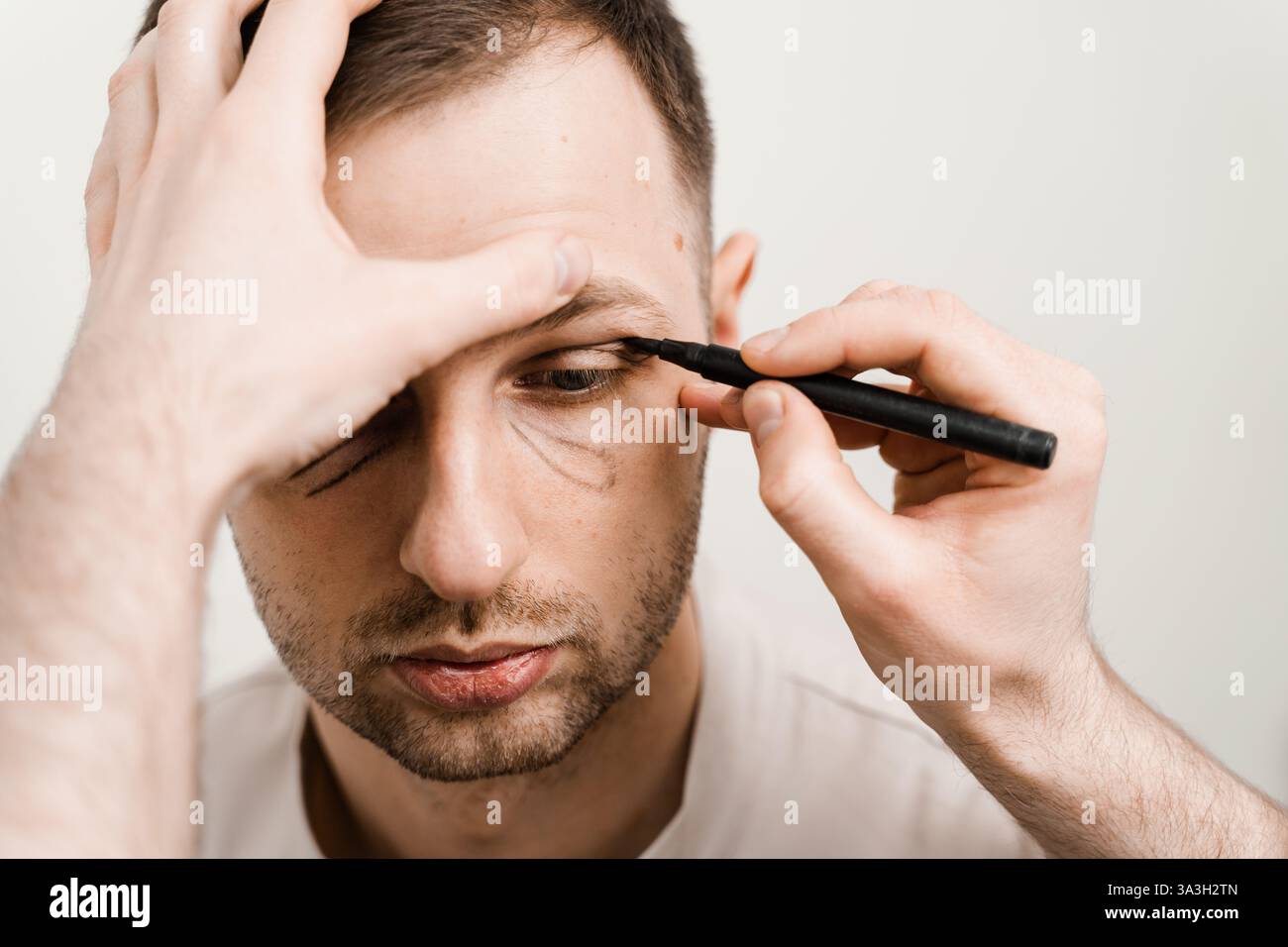 Male blepharoplasty and lower eyelid lift and hernia removal markup on ...