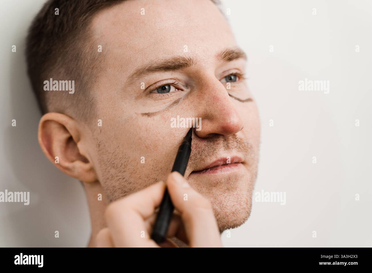 Male blepharoplasty and lower eyelid lift and hernia removal markup on ...