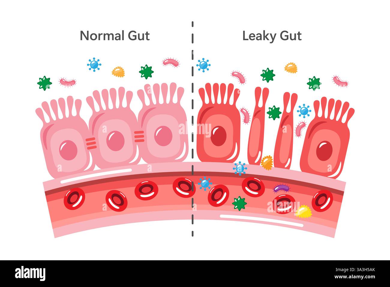 Leaky gut syndrome and healthy gut . Cute medical cartoon . Vector ...