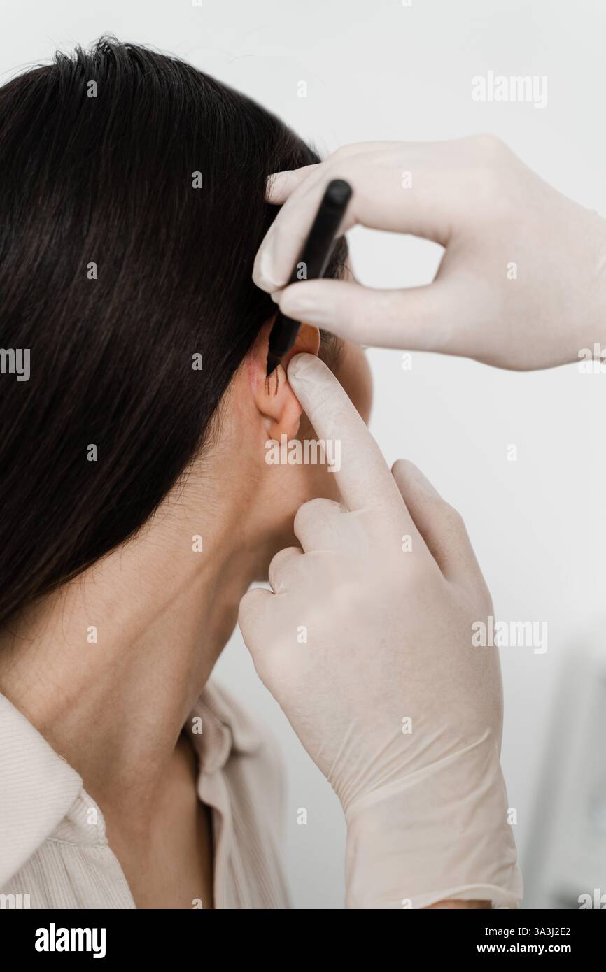 Surgeon draw marking on ear before otoplasty cosmetic surgery ...