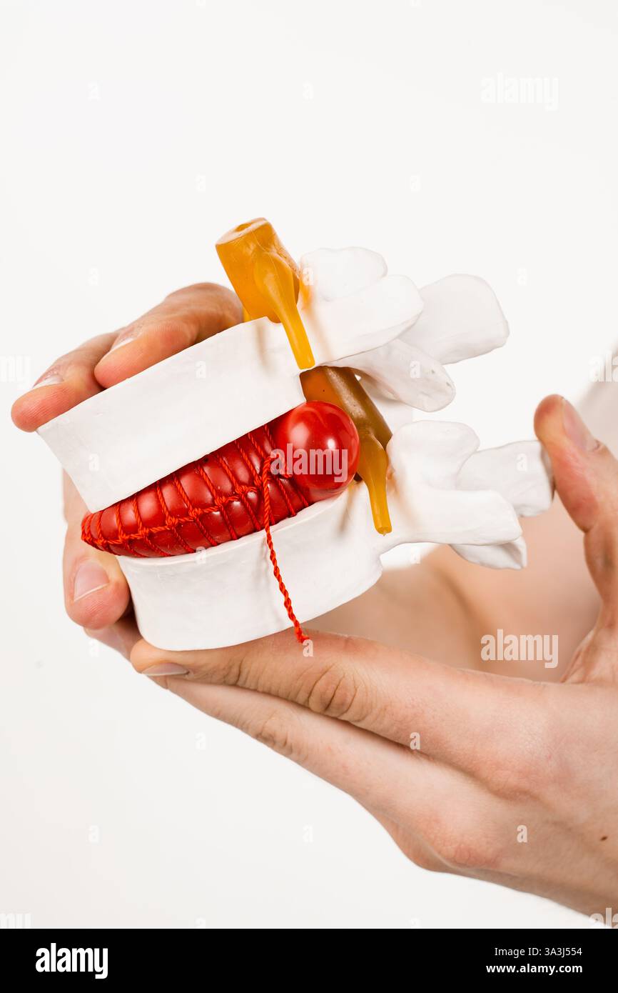 Lumbar hernia model with intervertebral hernia on white background ...