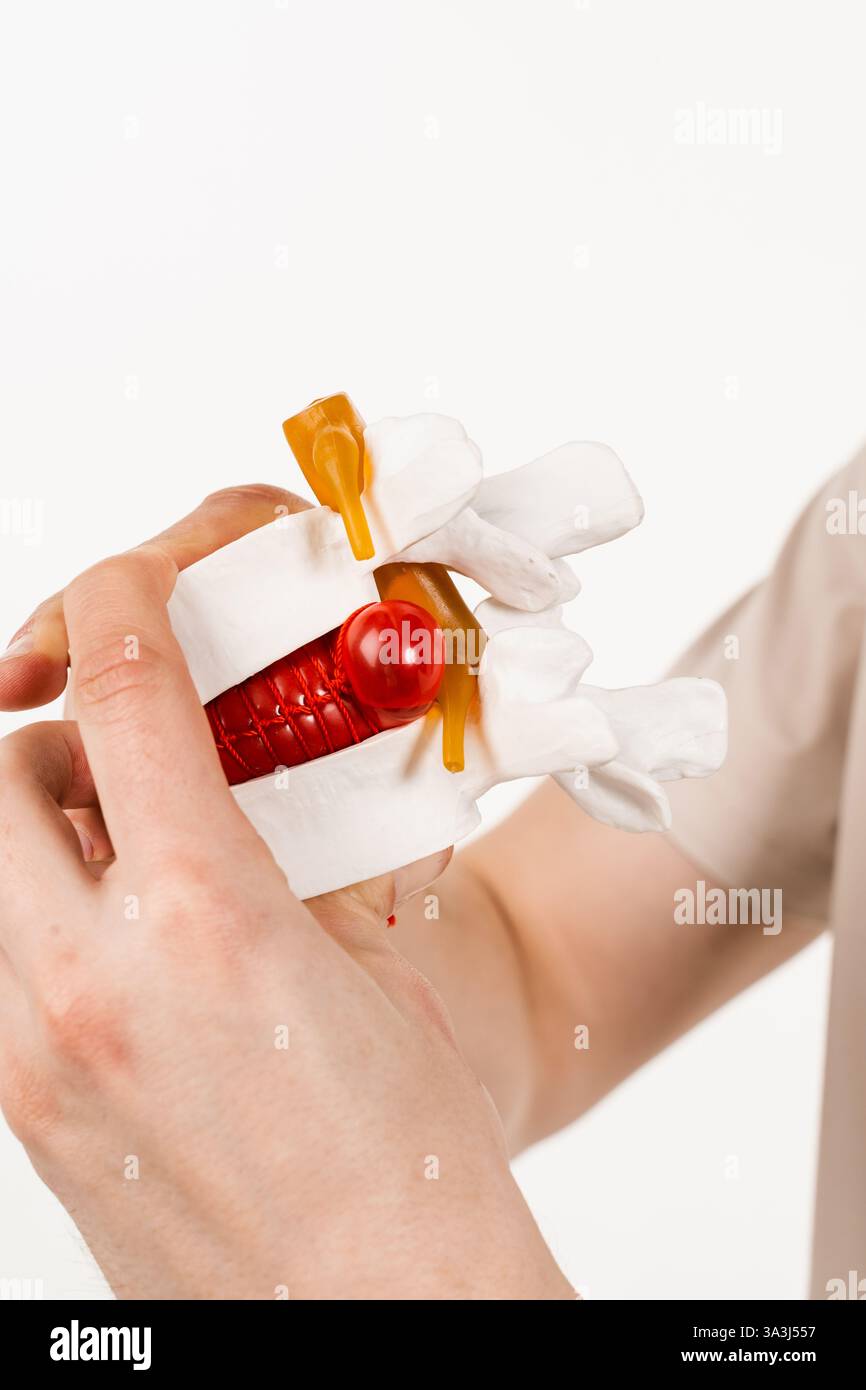 Lumbar hernia model with intervertebral hernia on white background ...