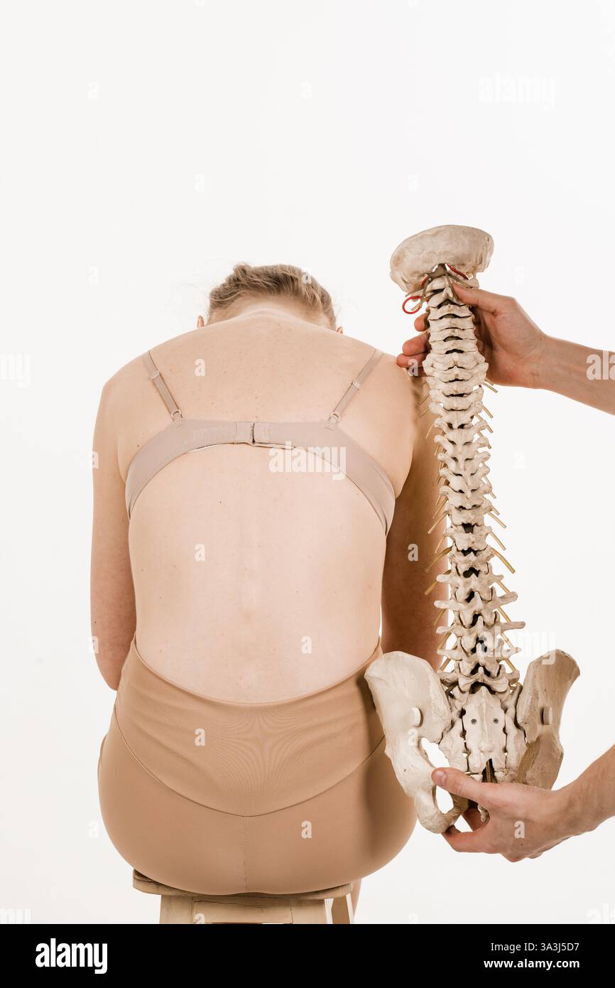 Scoliosis is sideways curvature of the spine. Backbone anatomical model ...