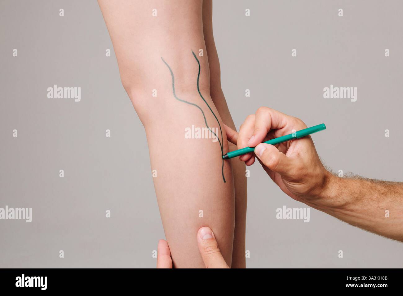 DVT. Woman is healing from deep vein thrombosis. Surgeon is drawing ...