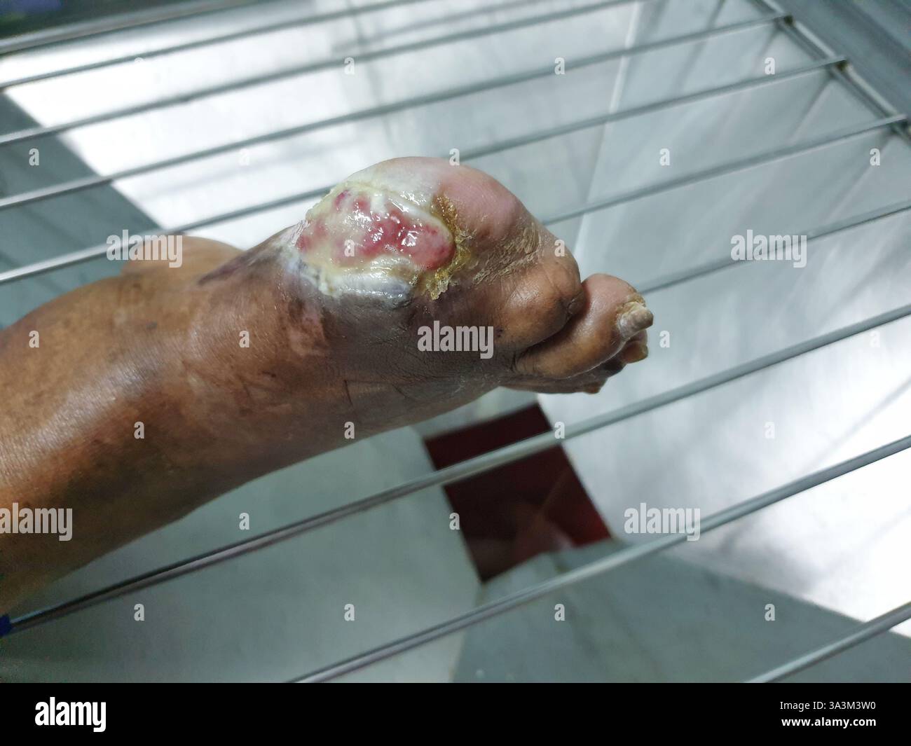 Patient healing wounds injury to tissue caused by diabetes mellitus on ...