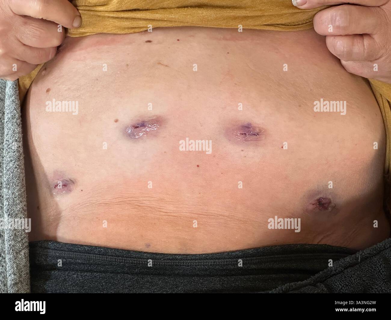 Orthoscopic surgey scars on a woman Stock Photo - Alamy