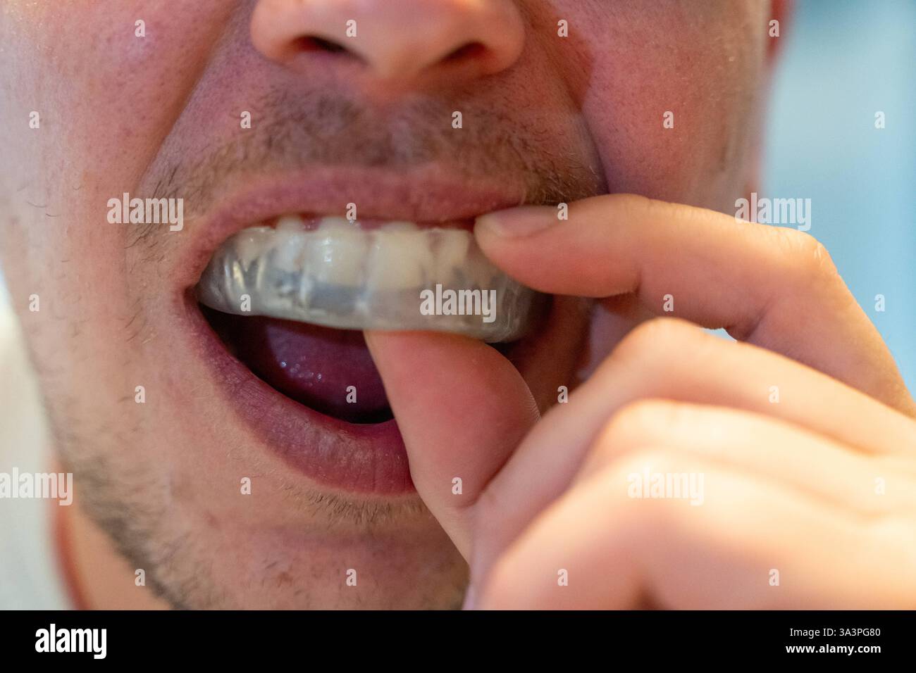 Bavaria, Germany - March 16, 2025: A person uses a grinding splint ...