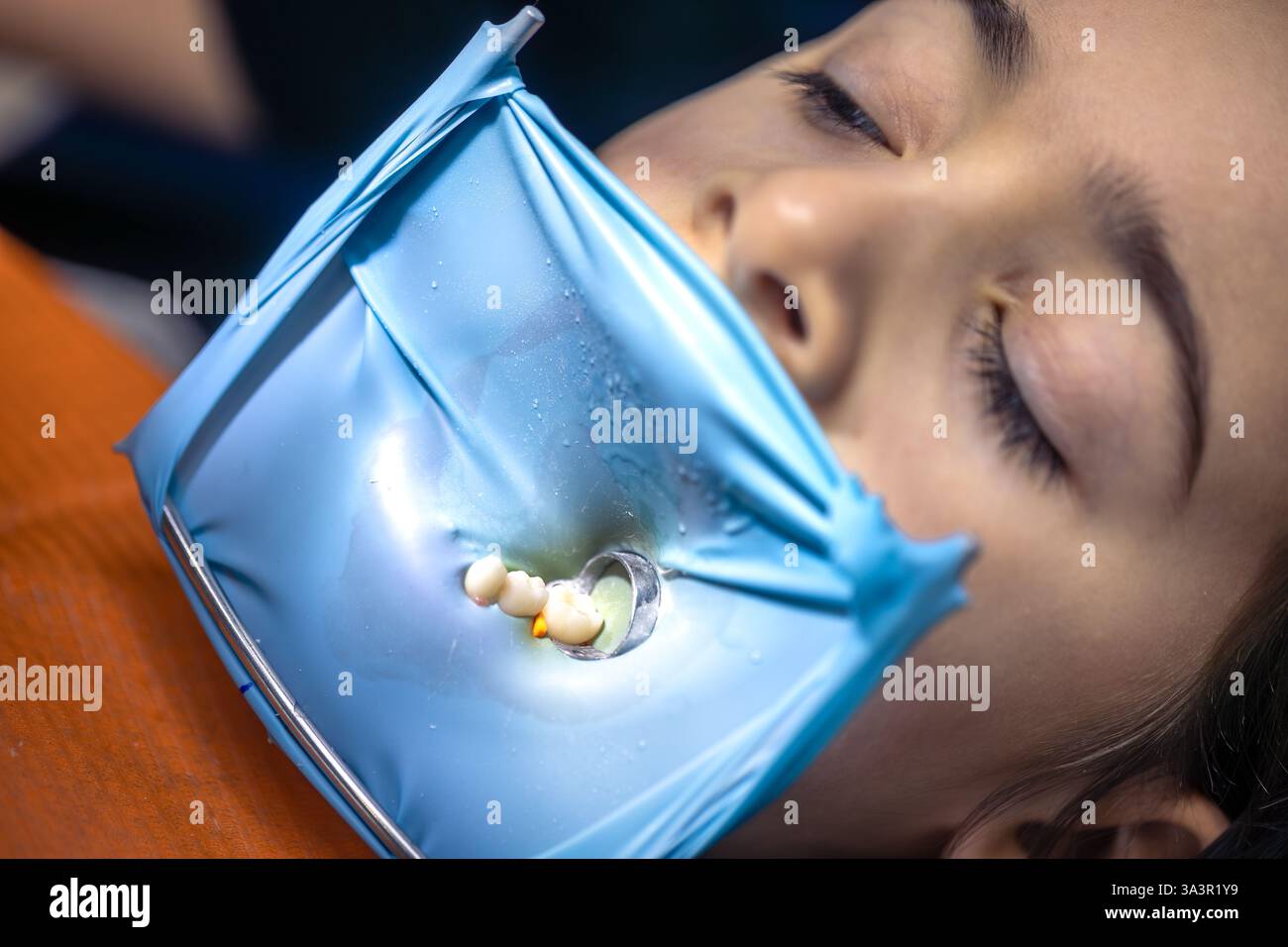 The dentist treats the child's tooth using a rubber dam. Close-up of ...