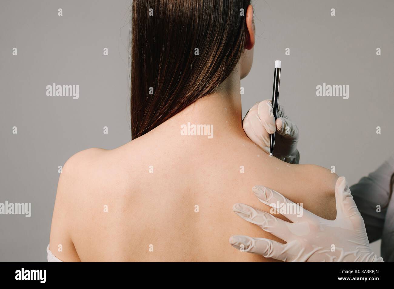 Doctor draws markings on the skin of the back for migraine treatment ...