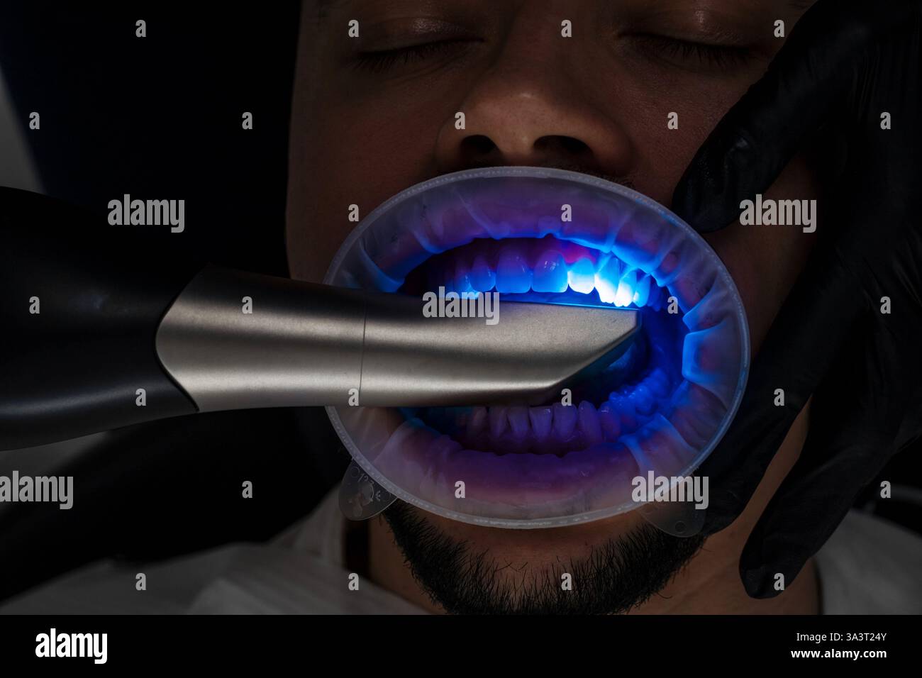 Digital impressioning teeth of patient with 3d digital dental scanner ...