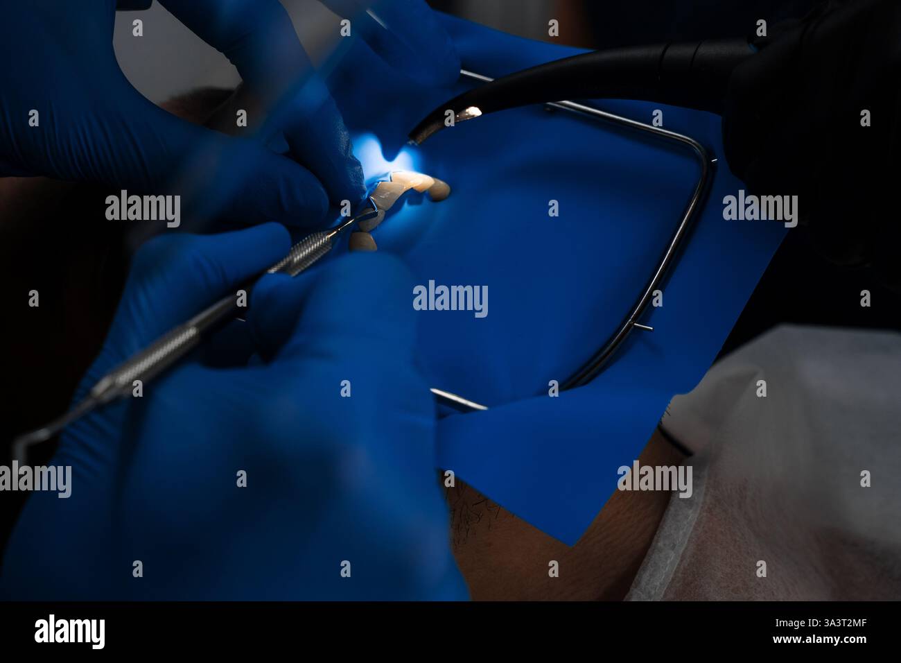 Dentist polishes patients teeth isolated by a rubber dam. Rubber dam ...