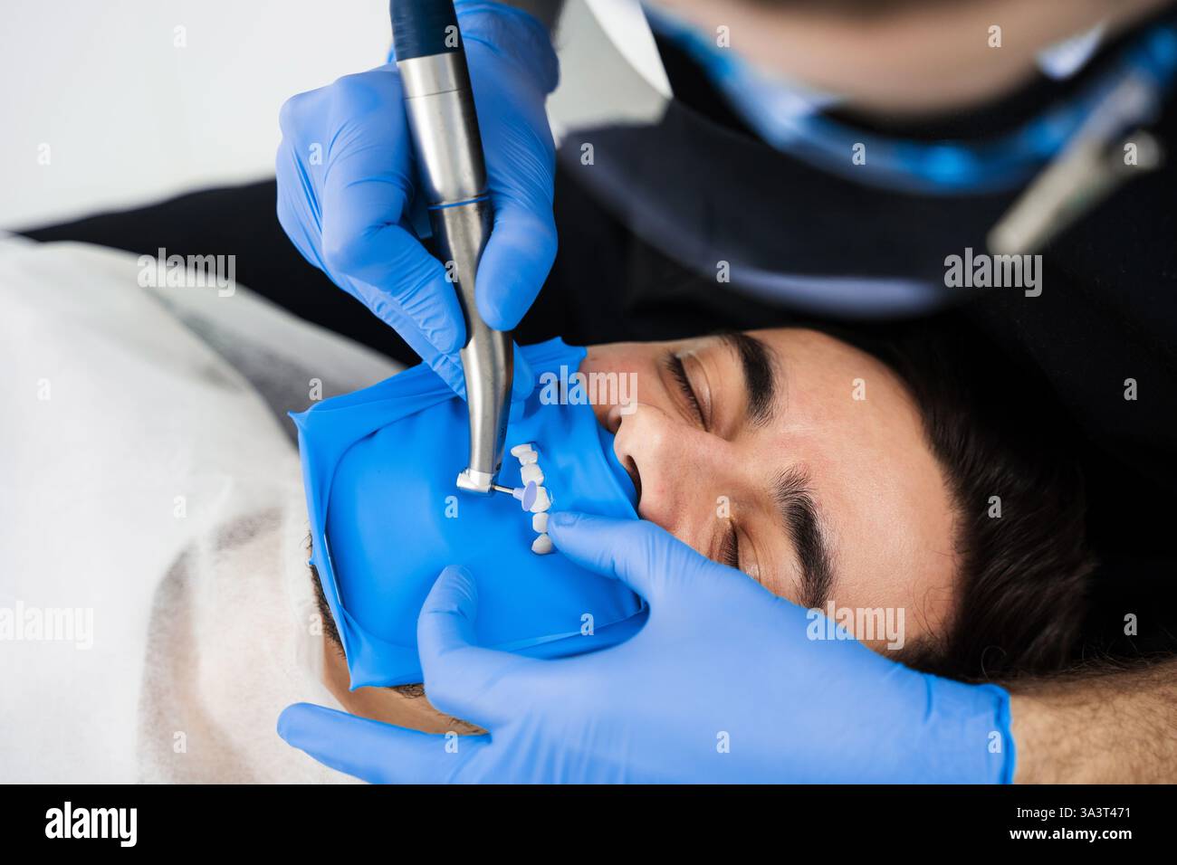 Dental veneers installing preparation. Dentist isolates teeth using ...
