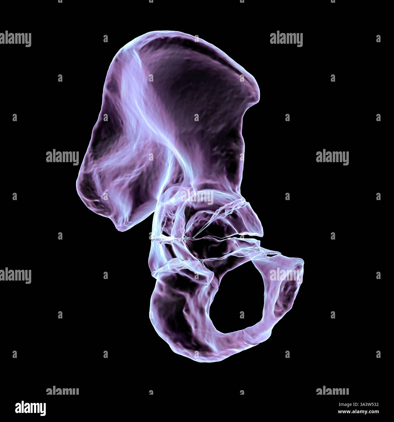 Illustration of pelvic bones with an acetabulum fracture, a break in ...