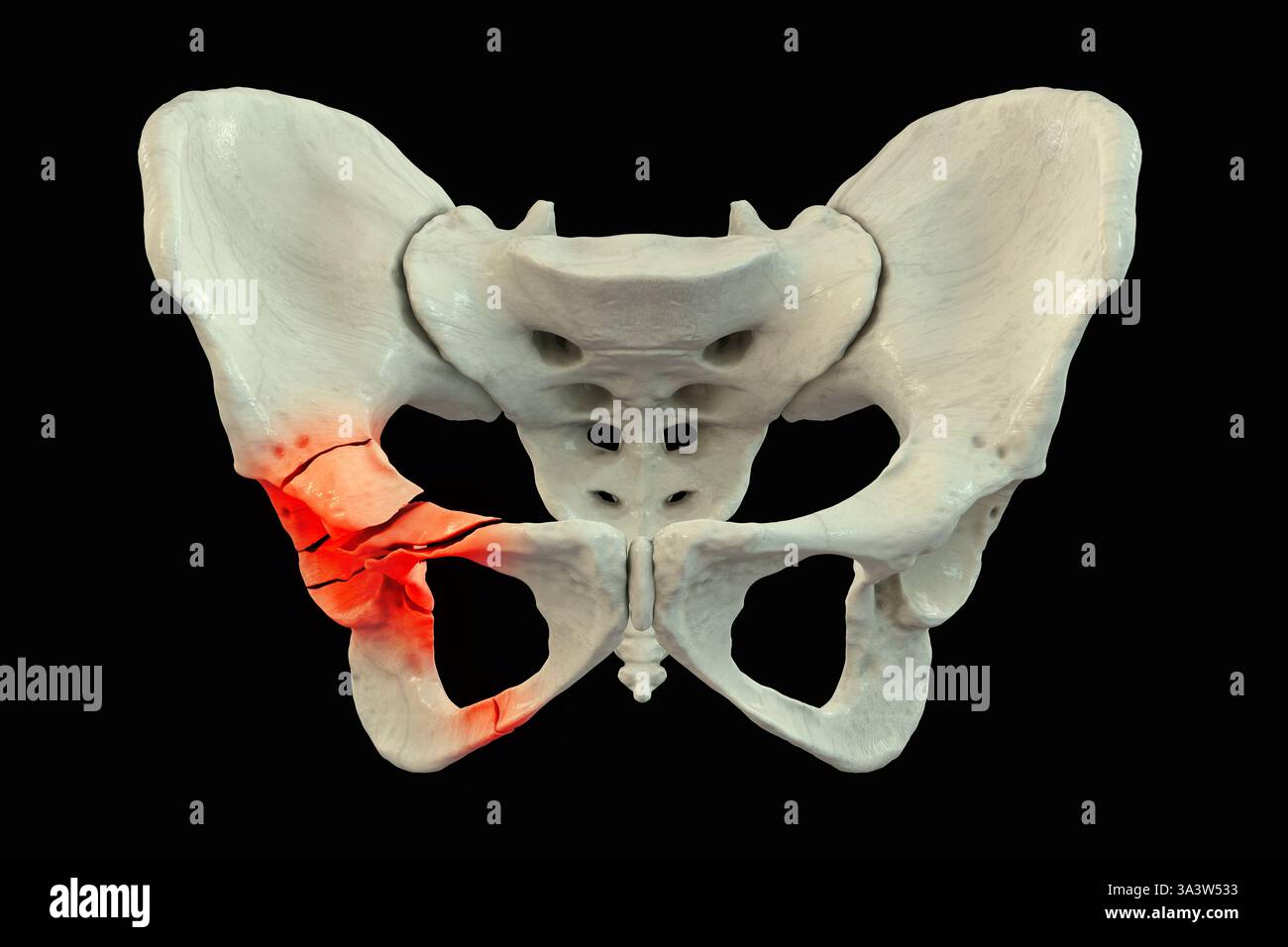 Illustration of pelvic bones with an acetabulum fracture, a break in ...