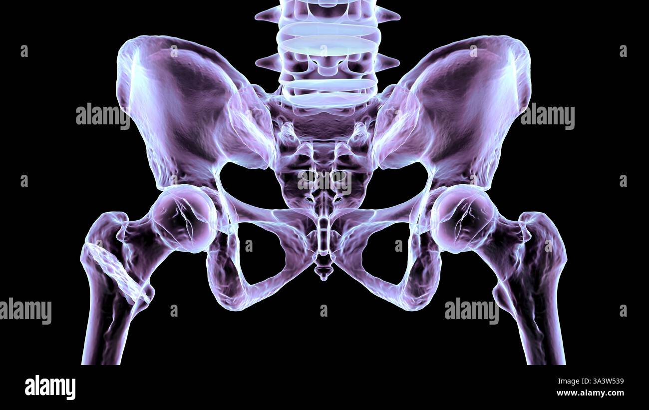 Illustration of an intertrochanteric femur fracture, showing a break ...
