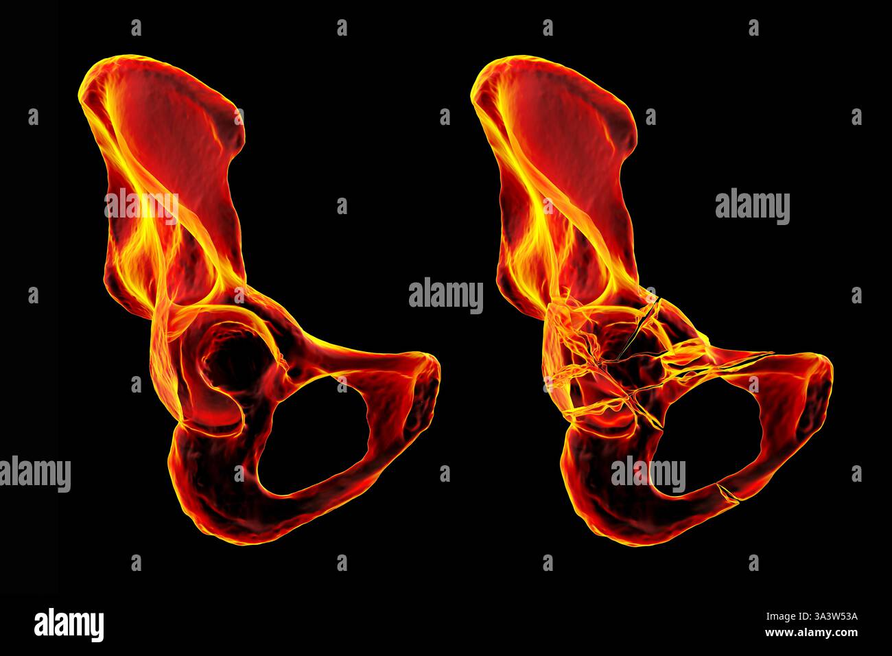 Illustration of pelvic bones with an acetabulum fracture (right) and ...