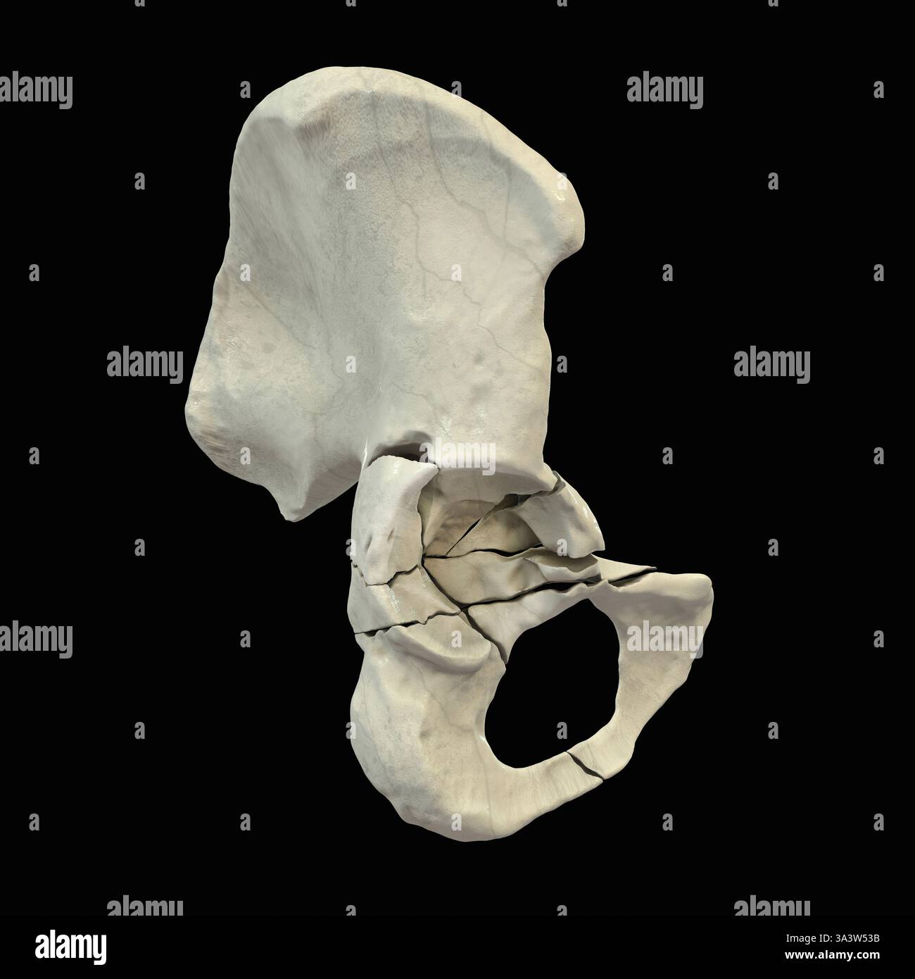 Illustration of pelvic bones with an acetabulum fracture, a break in ...