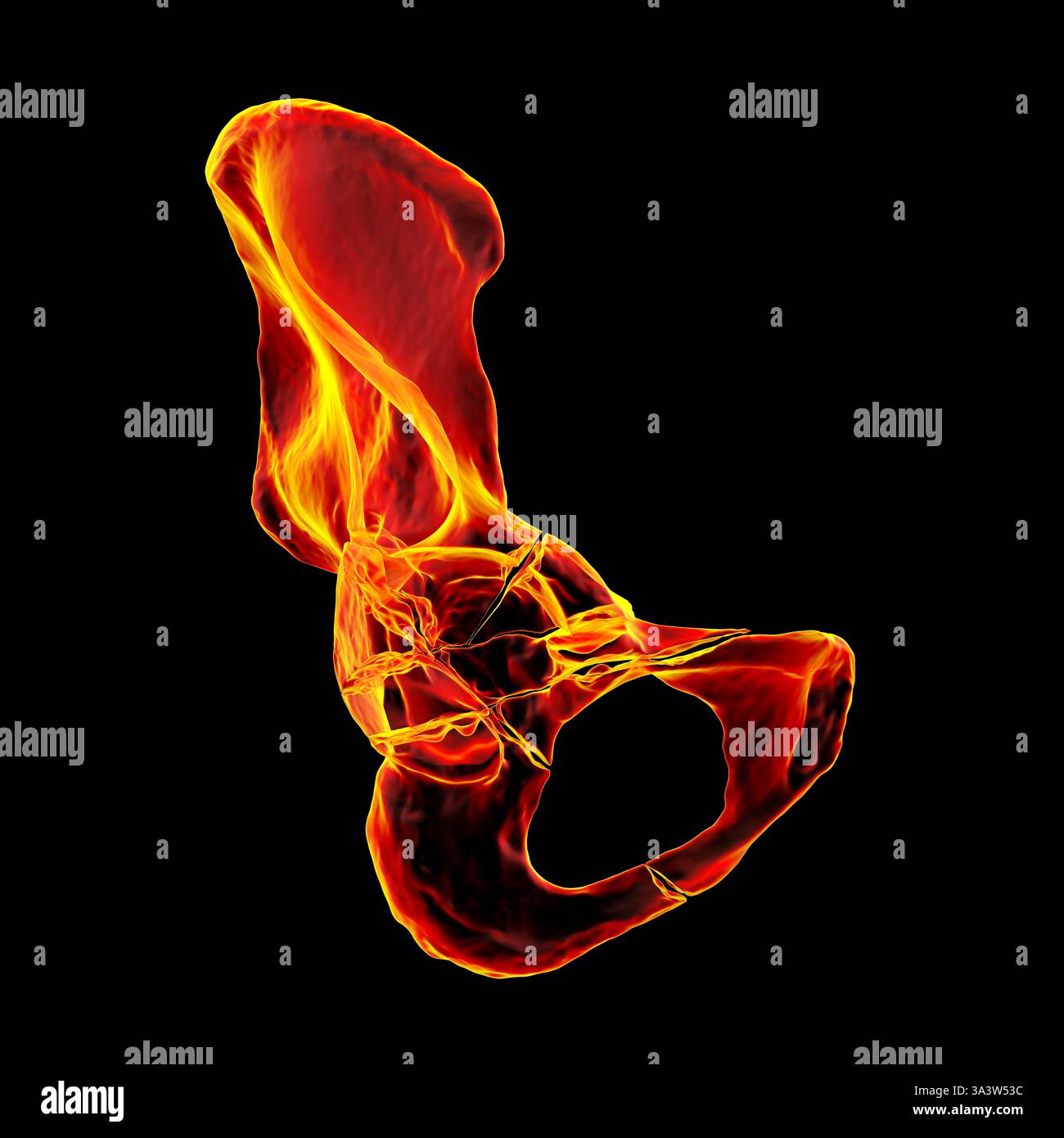 Illustration of pelvic bones with an acetabulum fracture, a break in ...