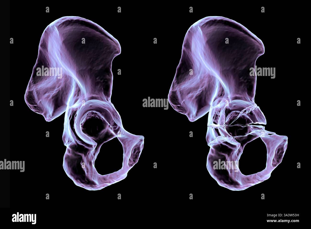 Illustration of pelvic bones with an acetabulum fracture (right) and ...