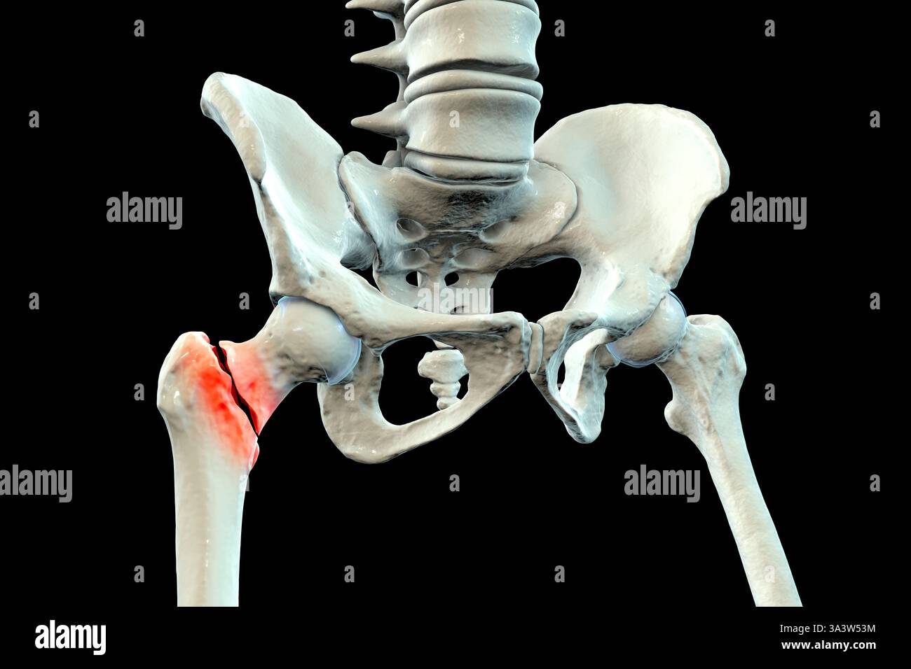 Illustration of a basicervical femur fracture, showing a break at the ...