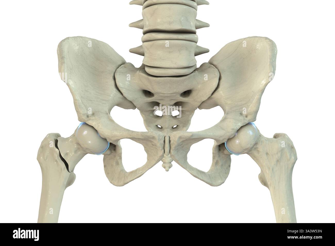 Illustration of a basicervical femur fracture, showing a break at the ...