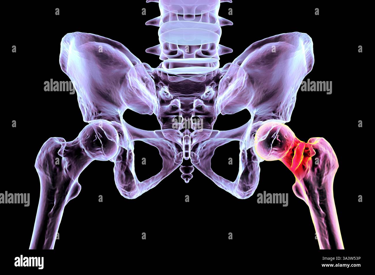 Illustration of a femur neck fracture, showing the bone breakage and ...