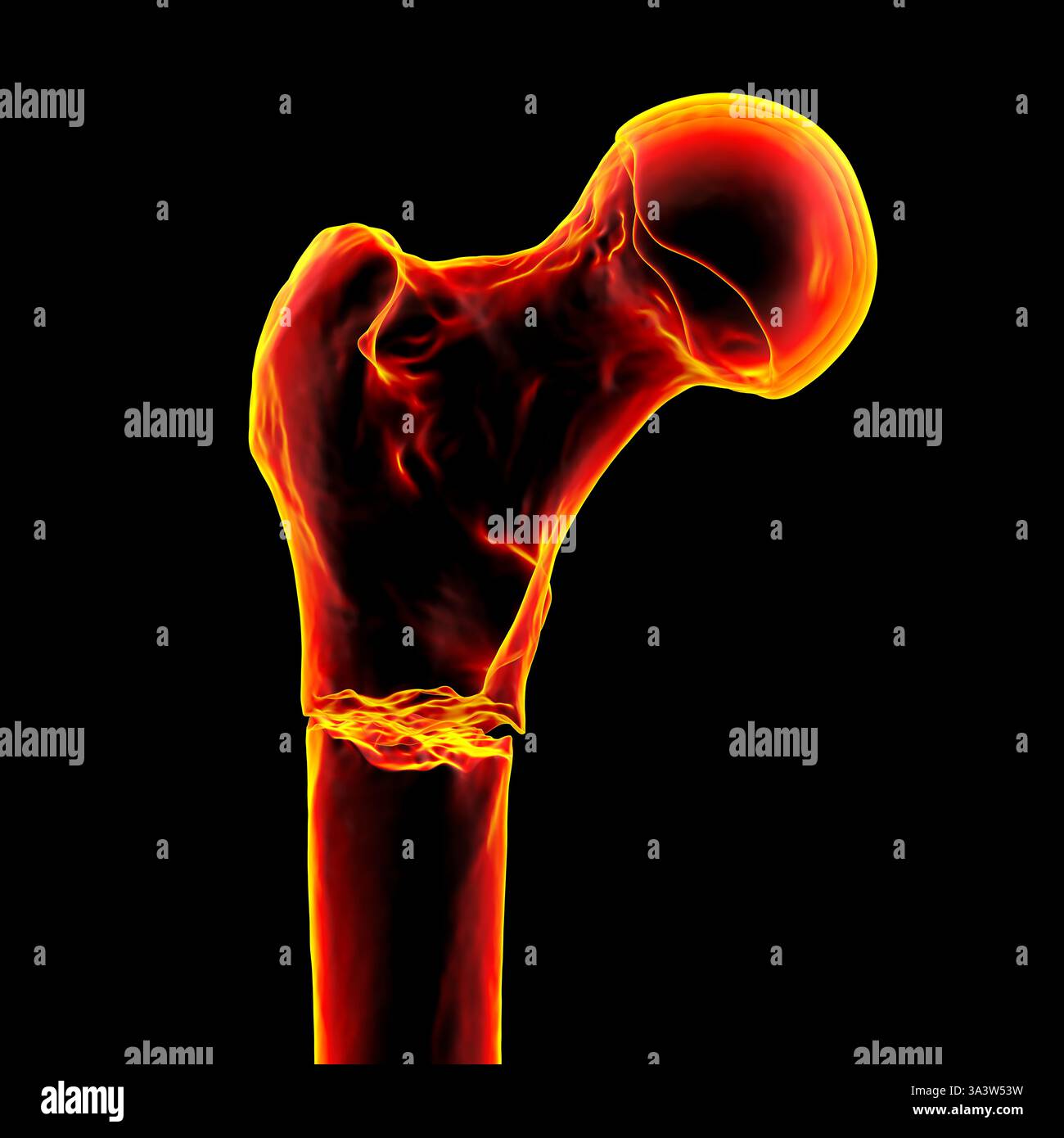 Illustration of a subtrochanteric femur fracture, depicting a break ...