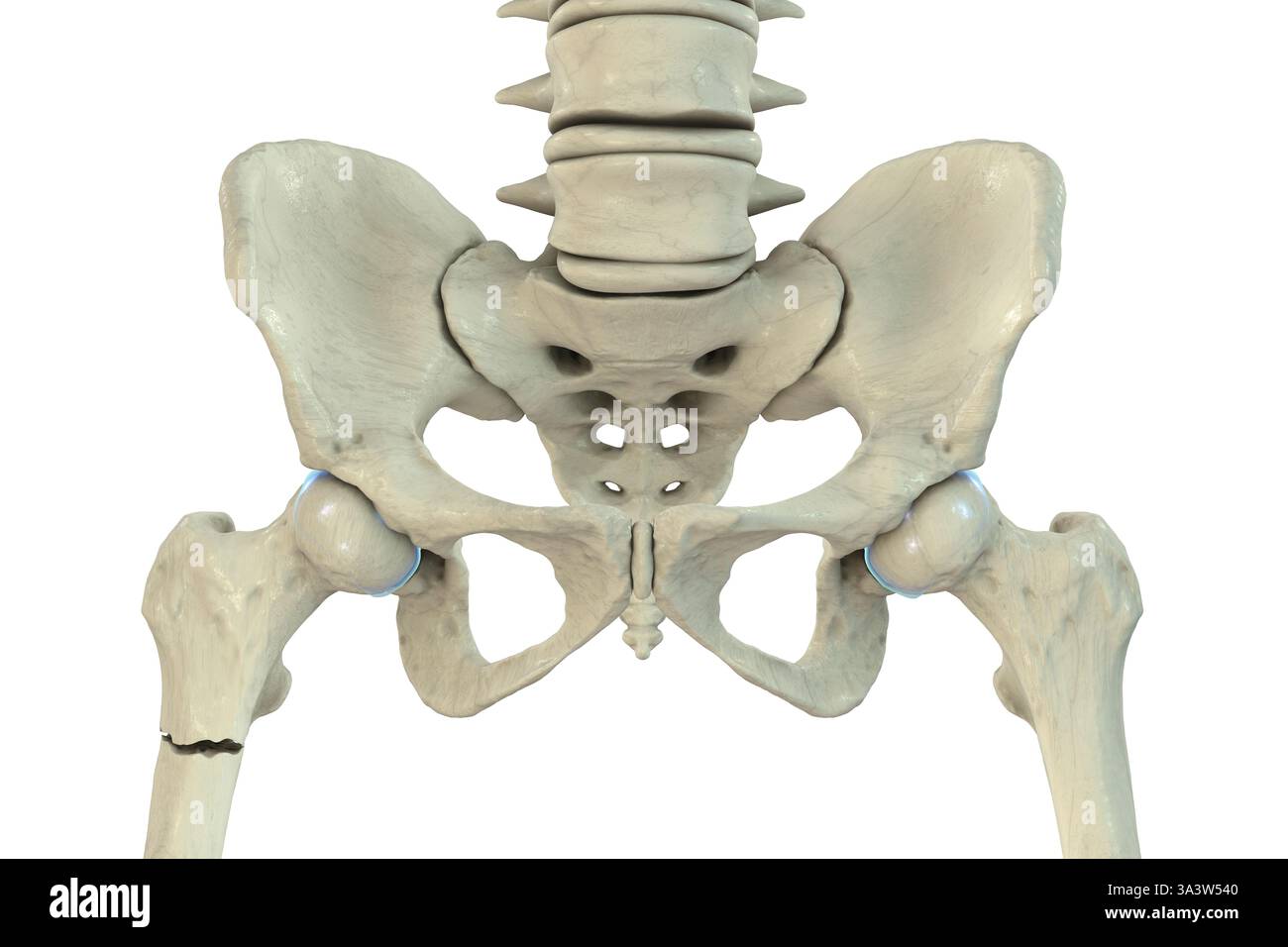 Illustration of a subtrochanteric femur fracture, depicting a break ...