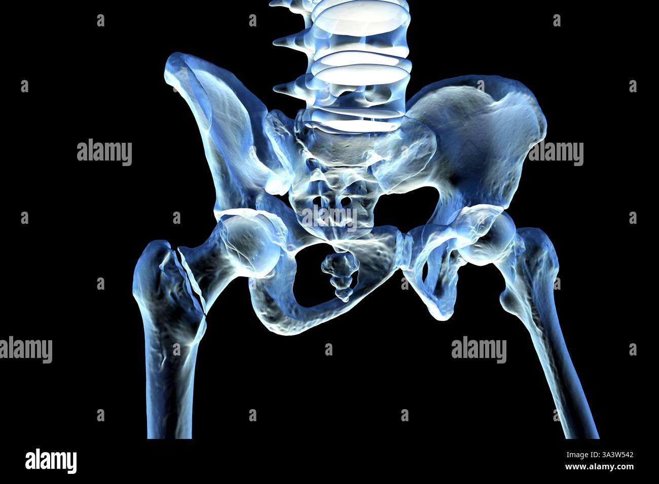Illustration of a basicervical femur fracture, showing a break at the ...
