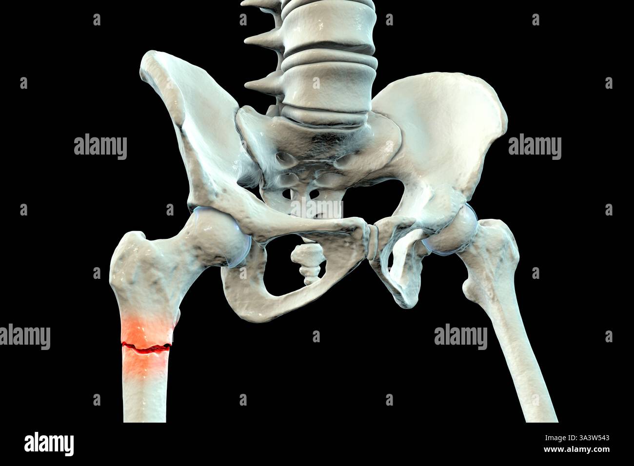 Illustration of a subtrochanteric femur fracture, depicting a break ...