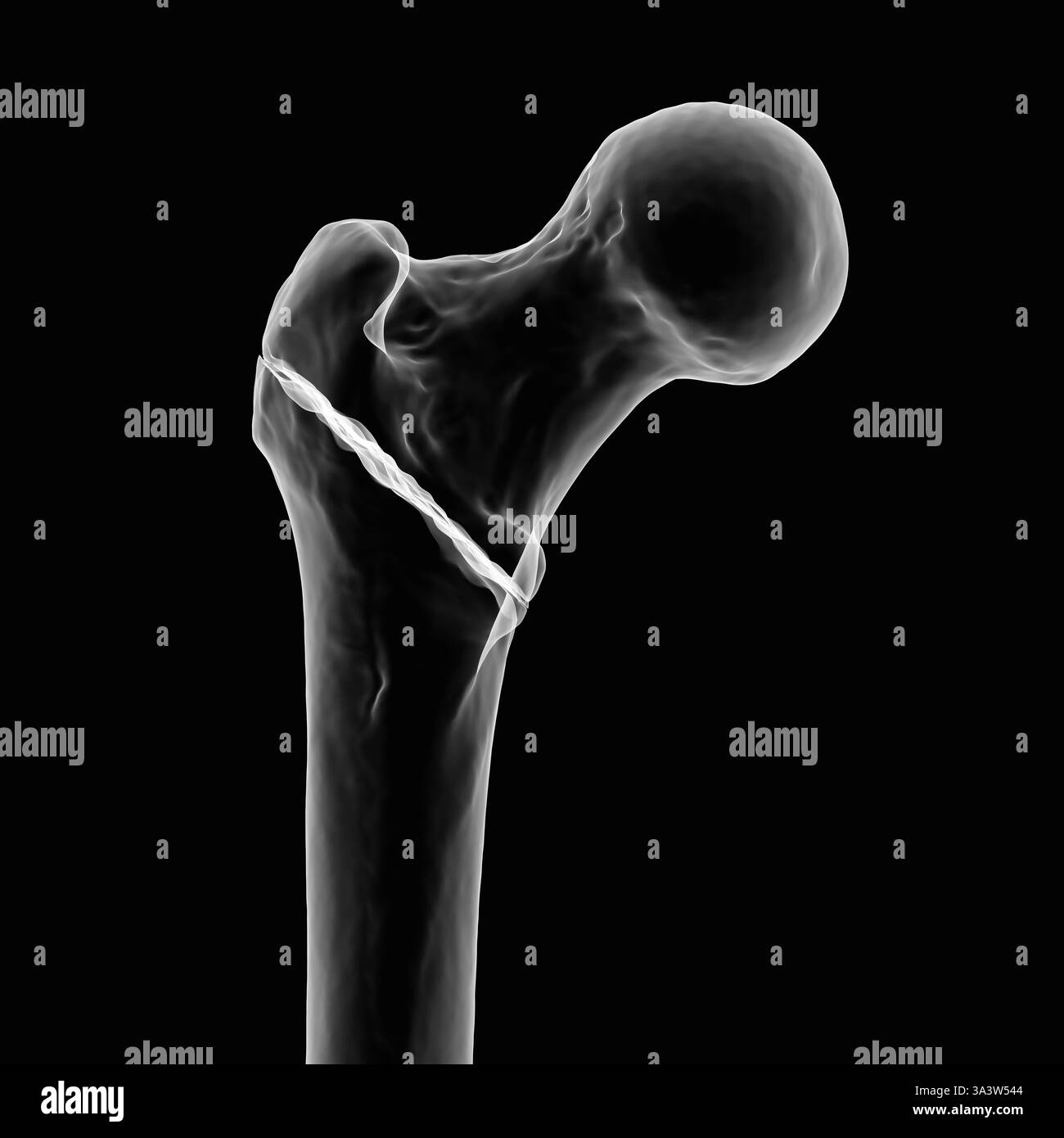 Illustration of an intertrochanteric femur fracture, showing a break ...