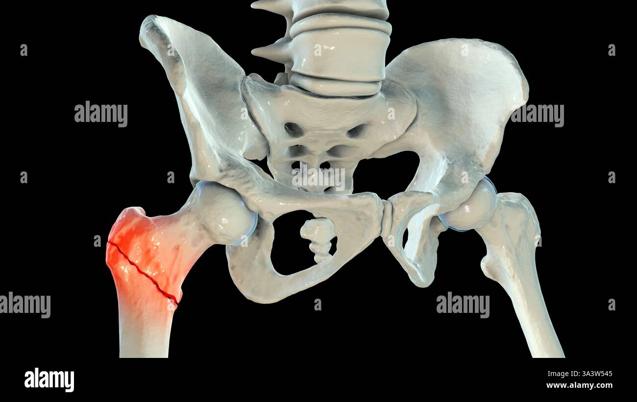 Illustration of an intertrochanteric femur fracture, showing a break ...