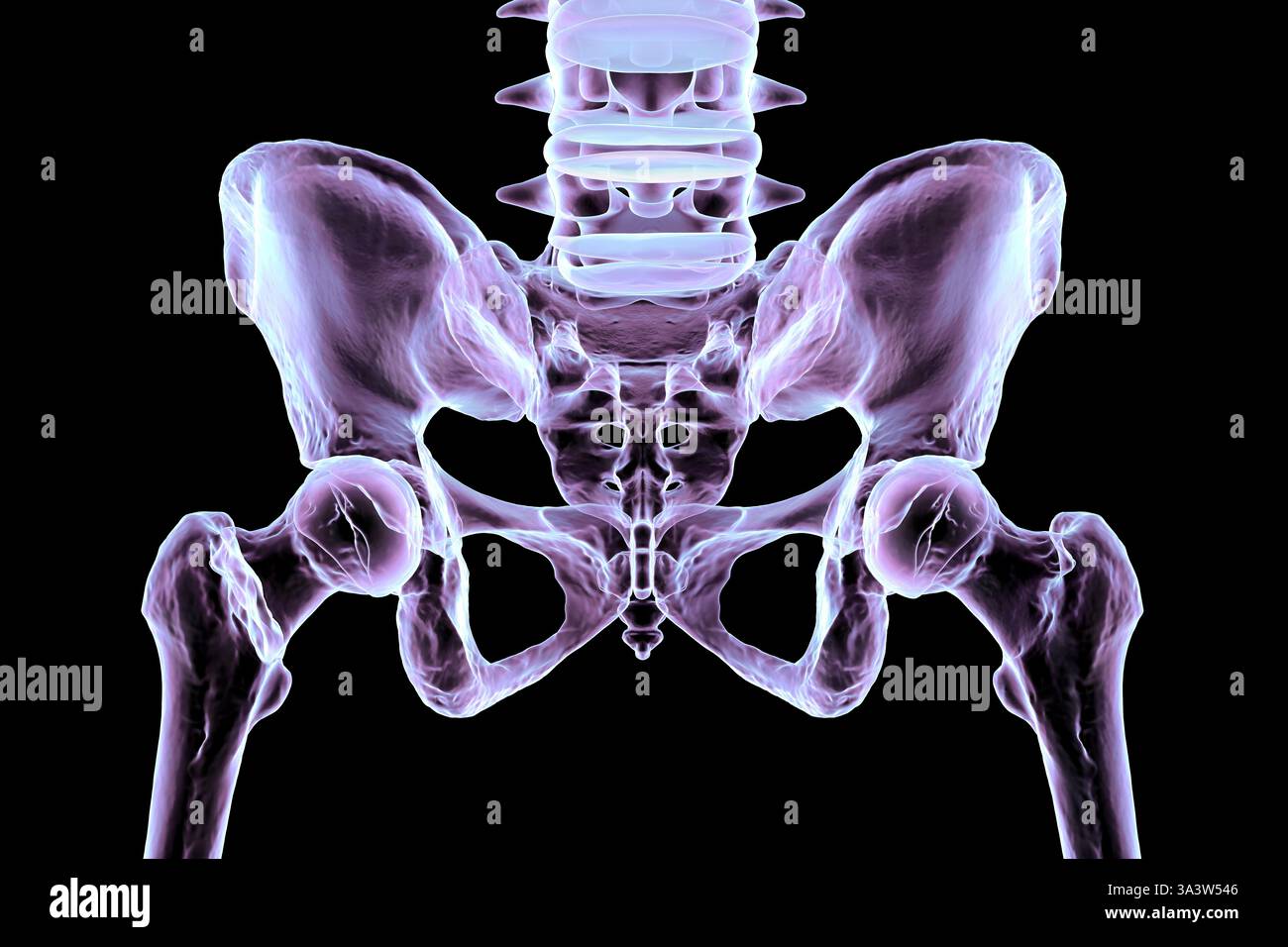 Illustration of a basicervical femur fracture, showing a break at the ...