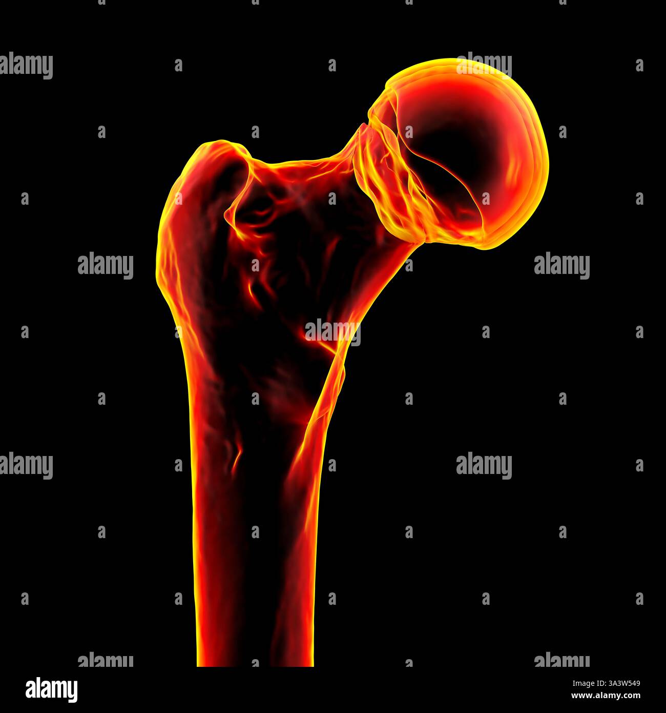 Illustration of a subcapital femur fracture, showing a break just below ...