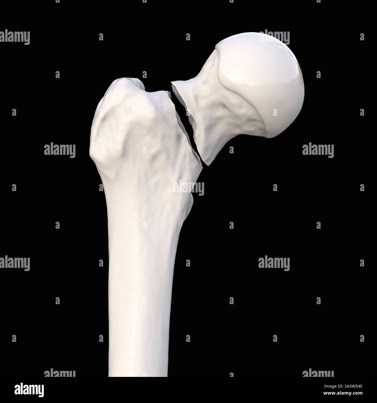 Illustration of a transcervical femur fracture, depicting a break ...