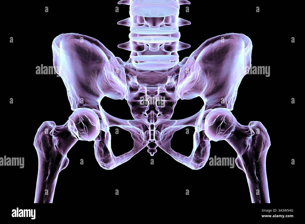 Illustration of a subcapital femur fracture, showing a break just below ...