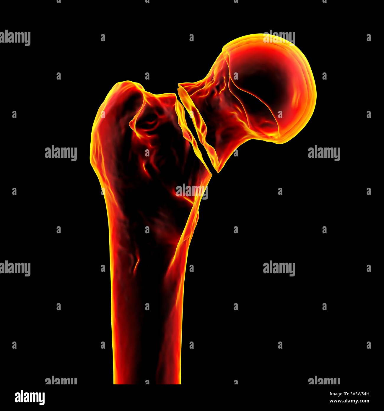 Illustration of a transcervical femur fracture, depicting a break ...