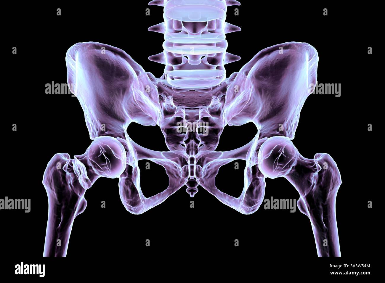 Illustration of a transcervical femur fracture, depicting a break ...