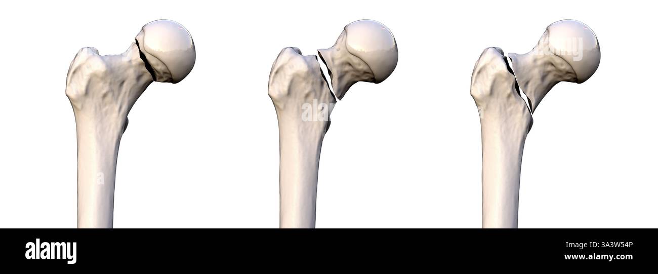 Illustration of femur neck fracture types: subcapital, transcervical ...