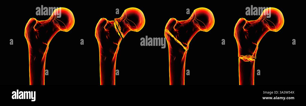 Bone fracture types hi-res stock photography and images - Alamy