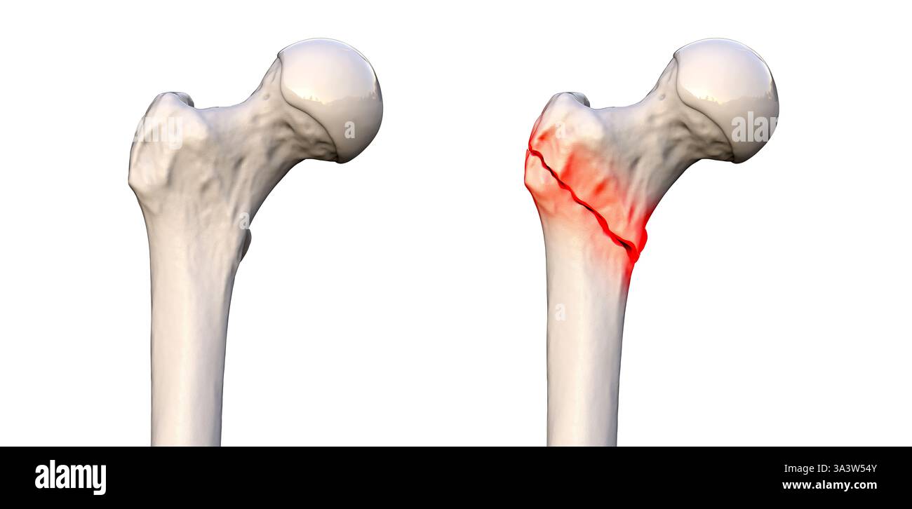 Illustration of an intertrochanteric femur fracture (right) showing a ...
