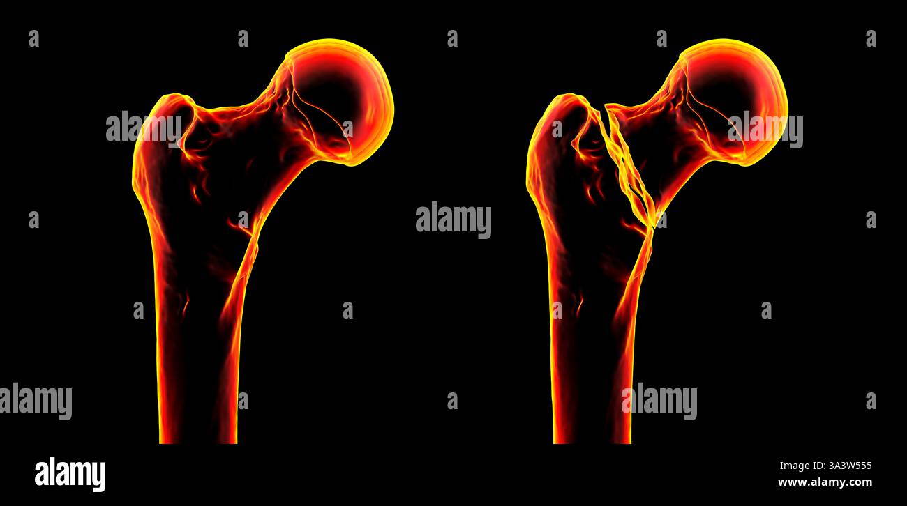 Illustration of a basicervical femur fracture (right) showing a break ...
